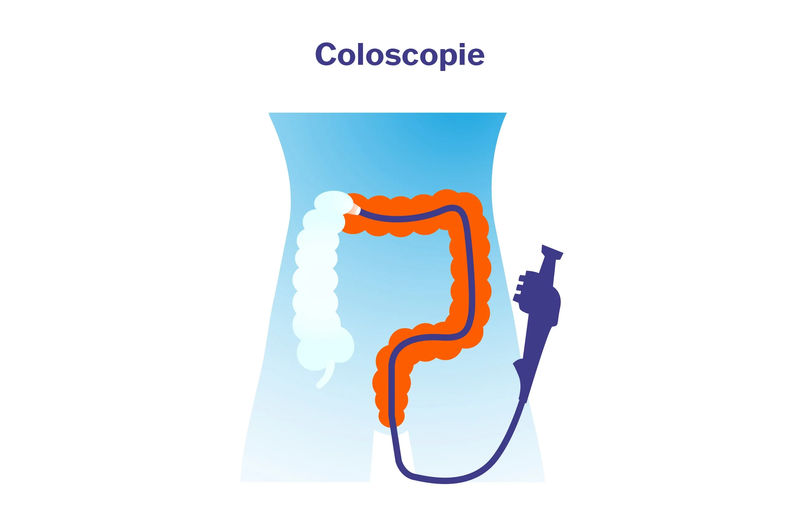 Tekening rond hoe een coloscopie werkt